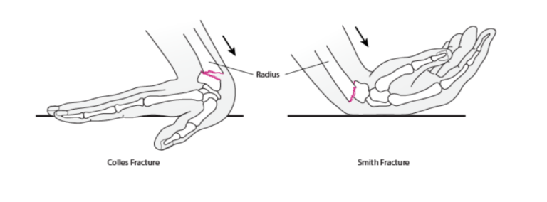 Colles and Smith Fractures | JAG Physical Therapy in NY, NJ, & PA