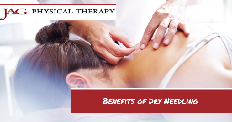 Benefits of Dry Needling | JAG Physical Therapy in NY, NJ, & PA
